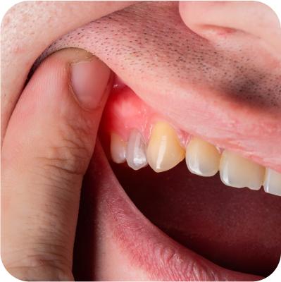 Bleeding Gums: Causes, Treatment & When to See a Dentist